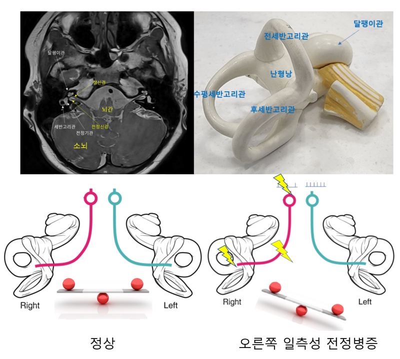 [BPPV][Edecational] Direction-Changing Nystagmus vs Direction-Fixed ...