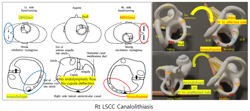 [BPPV][Edecational] Direction-Changing Nystagmus vs Direction-Fixed ...