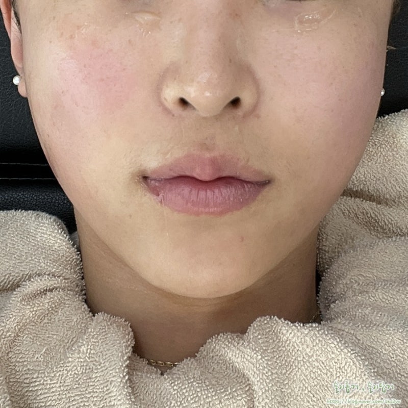 청담동 피부과에서 티타늄리프팅 받고 온 내돈내산 솔직후기 전후 사진 있음 네이버 블로그