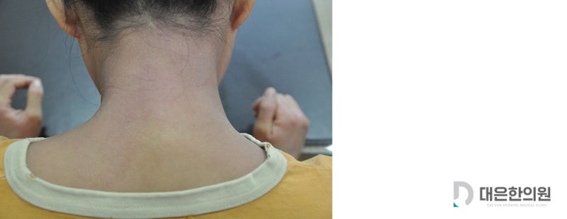 성인 아토피에 좋은 음식과 나쁜 음식 네이버 블로그