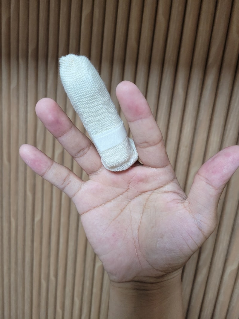 손가락골절 증상손톱괴사 및 빠짐 및 정형외과 치료비용 및 과정 알려드려요~ 재활운동 및 치료 그리고 현재상태 써아빠