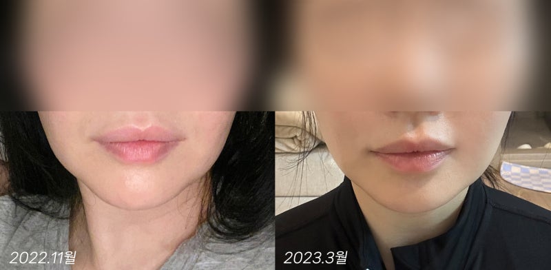 피부과 인모드 리프팅 효과 Fx And 포마 7개월 차 후기 내돈내산 가격 멍 통증 부작용 유지 주기 이중턱