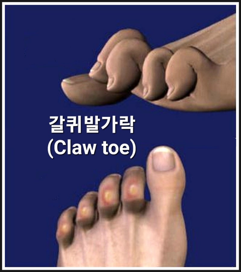 정강이 통증shin Splint 원인 전경골근앞정강근 Tibialis Anterior 긴장 네이버 블로그