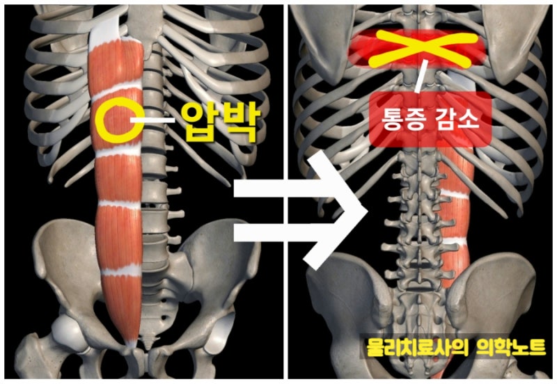 등허리, 등 통증 원인 - 복직근(배곧은근, Rectus abdominis)의 연관통(Referred pain) 양상 : 네이버 블로그