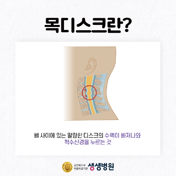 양방향 척추 내시경 수술 부천 신경외과 생생병원 네이버 블로그