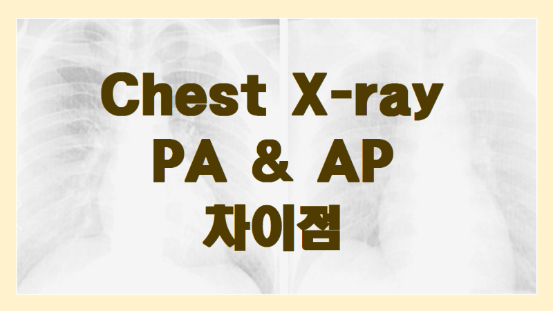 Chest x-ray : Chest PA / chest AP 차이점 : 네이버 블로그