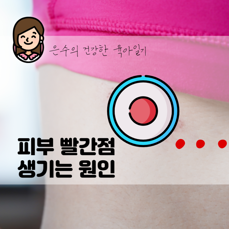빨간점 체리혈관종 버찌혈관종 원인 알아보아요 네이버 블로그