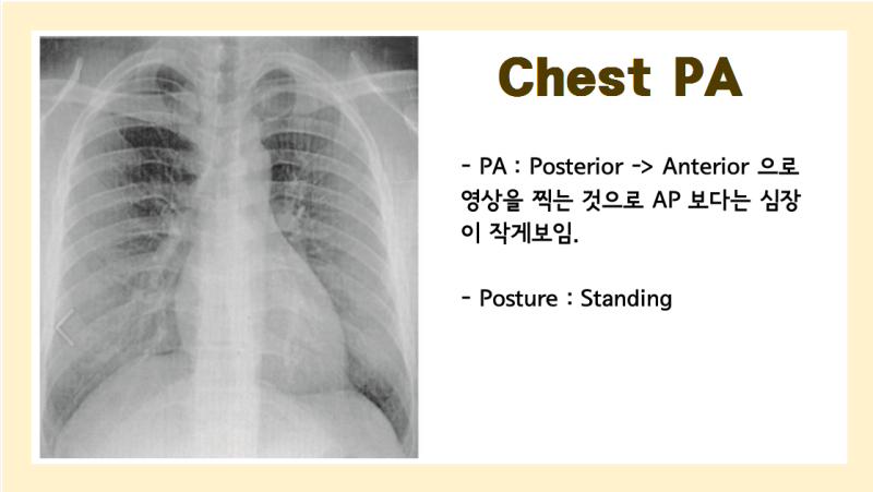 Chest x-ray : Chest PA / chest AP 차이점 : 네이버 블로그