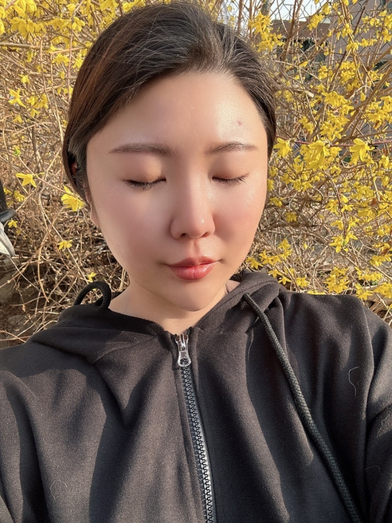 명동 피부과 여드름흉터 시크릿레이저 내돈내산 후기 네이버 블로그
