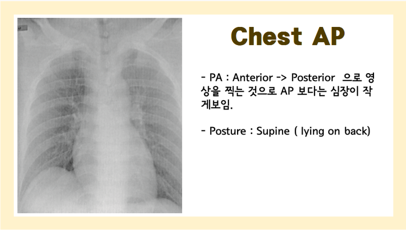 Chest x-ray : Chest PA / chest AP 차이점 : 네이버 블로그