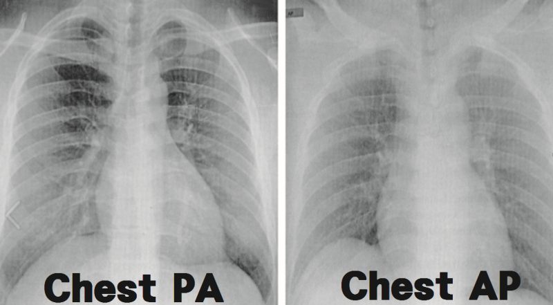 Chest x-ray : Chest PA / chest AP 차이점 : 네이버 블로그
