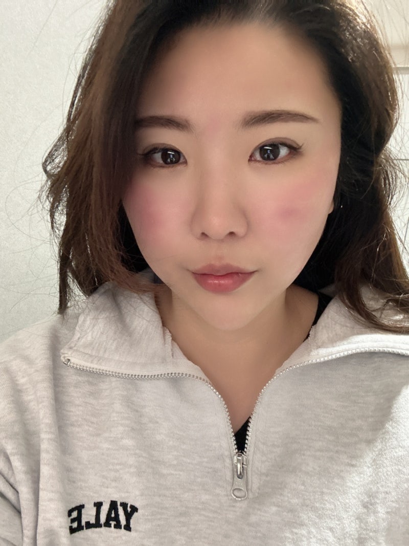 명동 피부과 여드름흉터 시크릿레이저 내돈내산 후기 네이버 블로그