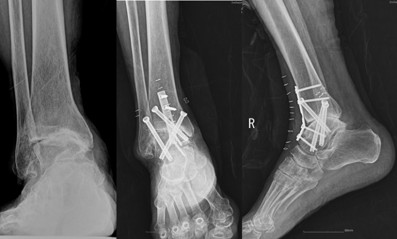 Ankle-Arthrodesis (AA) Tibio-talar fusion 발목관절 유합술 : 네이버 블로그