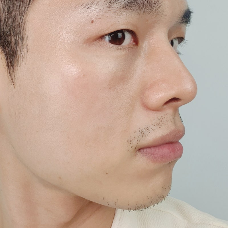 남자수염제모 후기 레이저 시술 가격 및 만족도 네이버 블로그