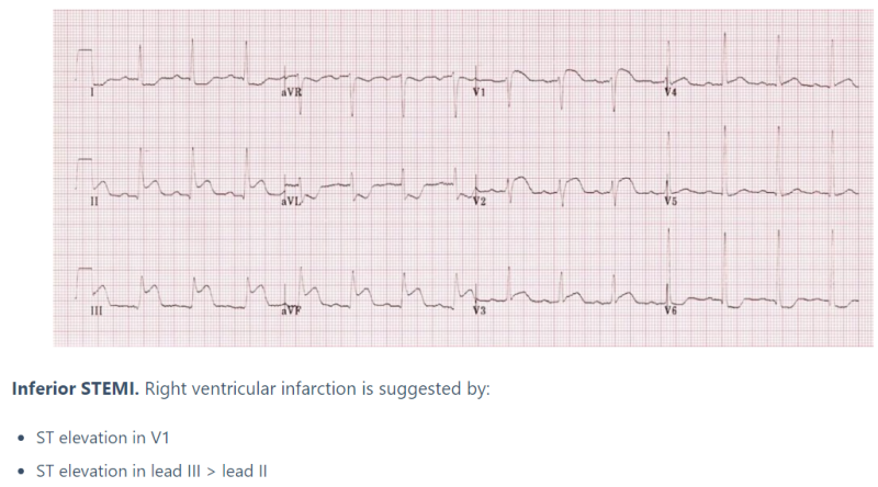 STEMI, RV infarction (우심실 STEMI, 우심실 경색), V4R 심전도 : 네이버 블로그