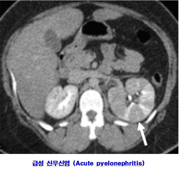급성 신우신염의 원인 증상 진단 치료 합병증 네이버 블로그
