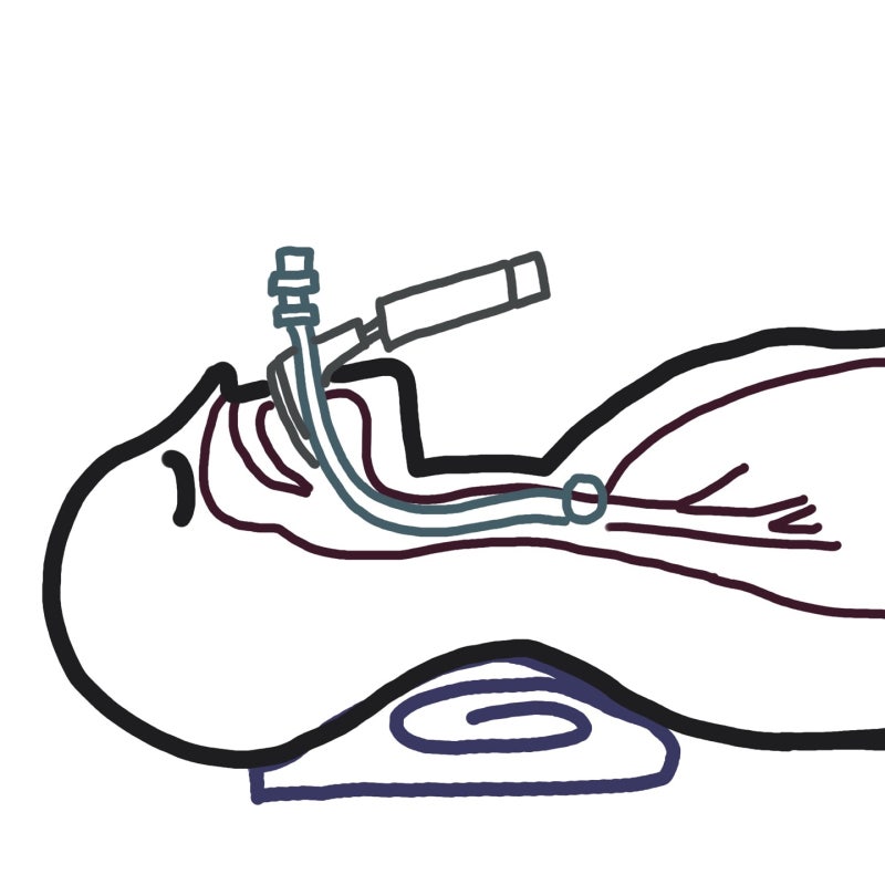 Intubation 인투베이션 : 꼭 알아야할 준비 사항/ assist / 전후 간호 : 네이버 블로그