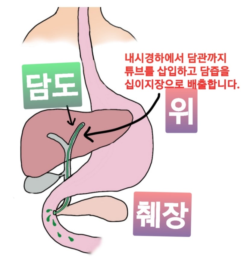 ENBD, ERBD, PTCD, EST, EPBD, ERCP의 검사 차이와 개요 : 네이버 블로그