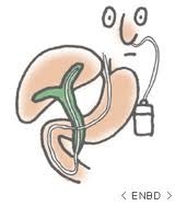 ENBD, ERBD, PTCD, EST, EPBD, ERCP의 검사 차이와 개요 : 네이버 블로그