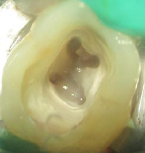 [엔도] 근관치료 이야기 4 (Feat. Apical Patency, Glidepath, Canal Shaping) : 네이버 블로그