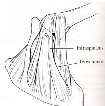 [관절경/어깨] Shoulder arthroscopy / Lateral position : 네이버 블로그