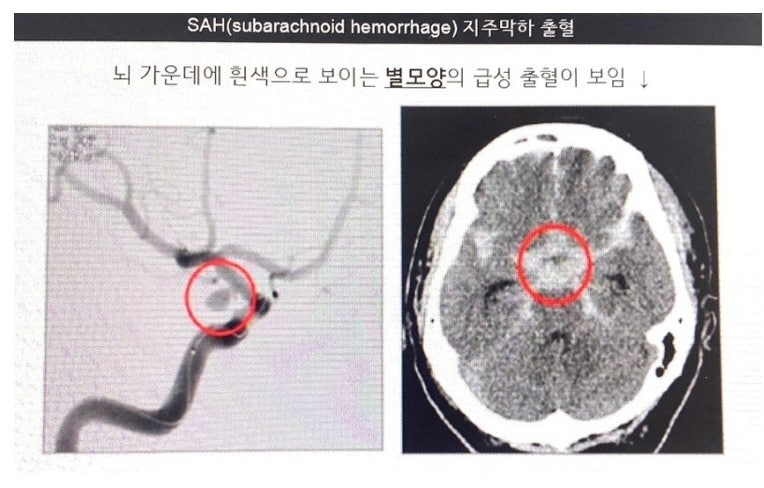 의학용어 EDH, SDH, SAH, ICH, IVH 증상, 치료, 간호! : 네이버 블로그