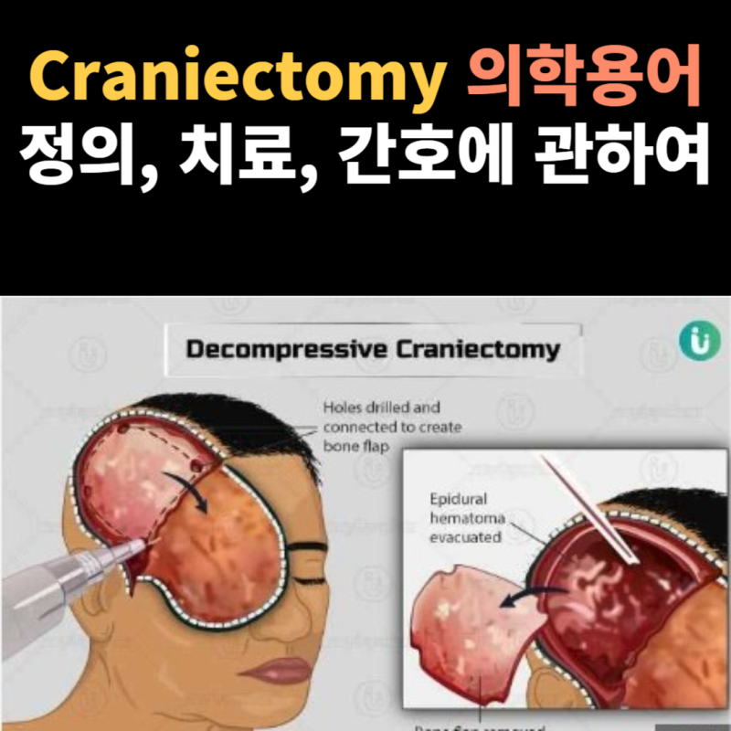 Craniectomy 의학용어 두개절제술 정의, 치료, 간호에 대하여 : 네이버 블로그