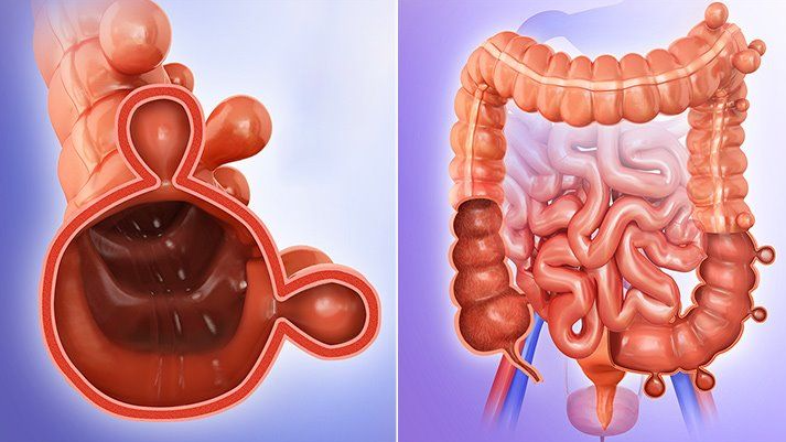 게실염 입원 및 통원 치료 대장 게실증 원인 초기증상 관리 방법 네이버 블로그