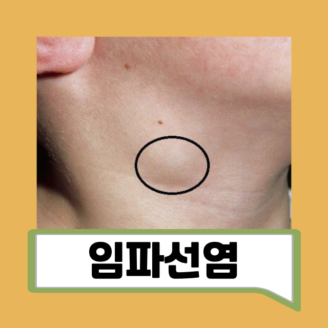 임파선부었을때병원 가야하는 증상 및 목 임파선염 원인 치료 네이버 블로그