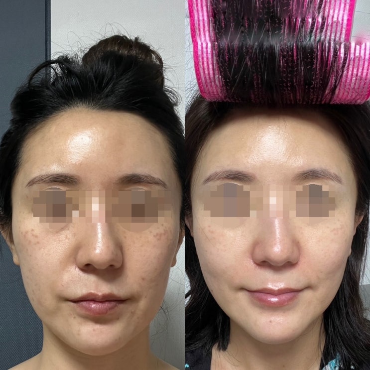 홍대 오타모반 기미 잡티 레이저 치료 내돈내산 후기 2탄 피부과 선택 꿀팁