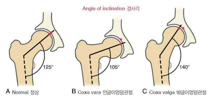 [국시 핵심정리]엉덩관절(Coxa vara, valgus)과 밖굽이 무릎(valgus knee), 안굽이무릎(varus knee ...