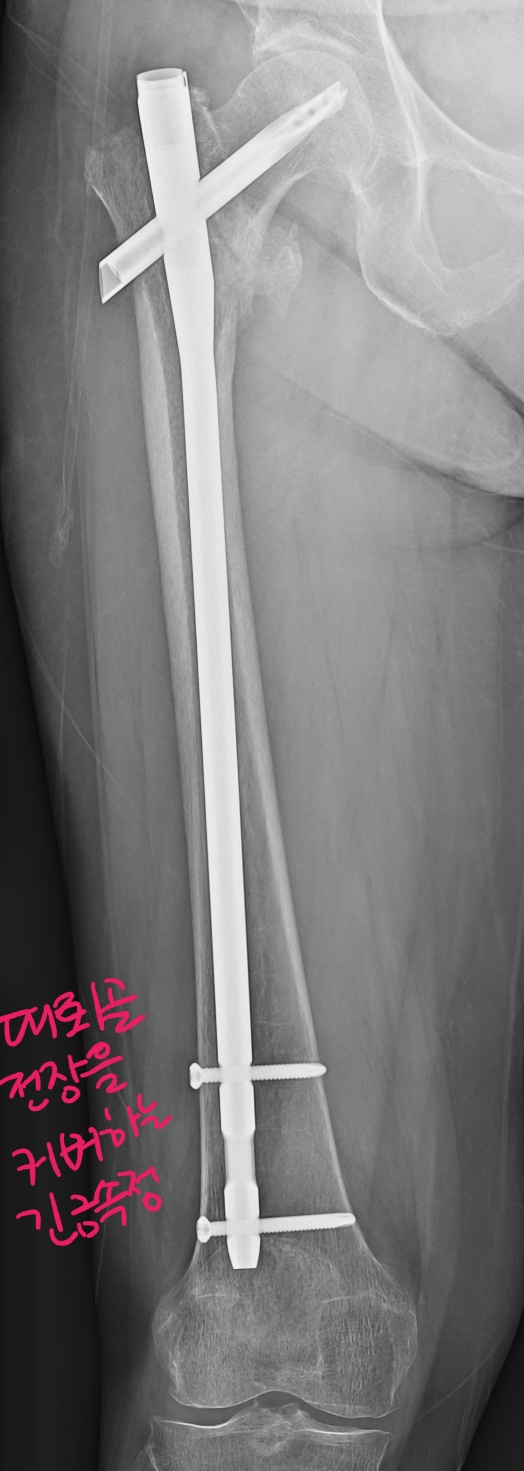 70대 대퇴전자간골절 (Femur Intertrochanter Fracture) 금속정 고정 수술 후 xray 변화 및 보행 ...