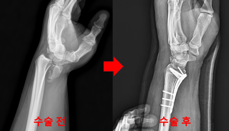바톤 골절 Barton Fracture 젊은 환자의 손목 골절 및 탈구 수술 후 재활 후기 네이버 블로그