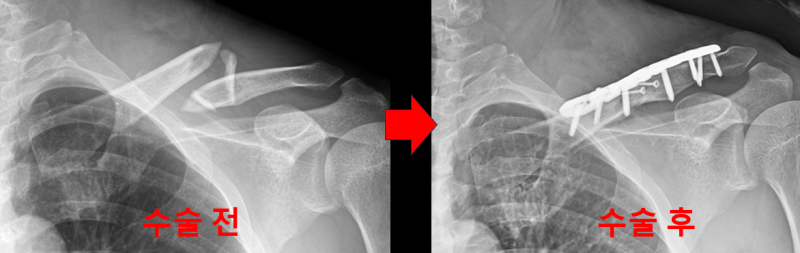자전거 낙상 후 발생한 쇄골 분쇄골절 Clavicle Comminuted Fracture 증상과 수술 치료 후 경과 Ft