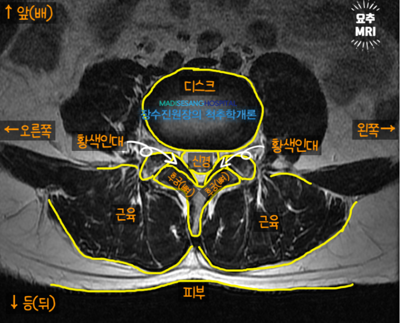 BESS (biportal endoscopic spine surgery), 수술 준비물, 수술과정 : 네이버 블로그