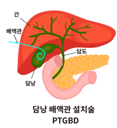 PTGBD, PTBD 차이, 간호 및 irrigation : 네이버 블로그