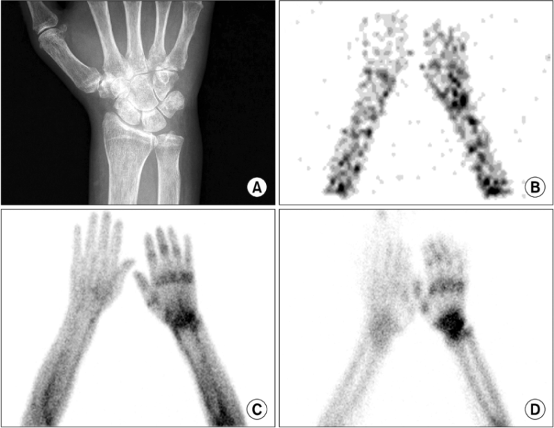 CRPS(Complex Regional Pain Syndrome)_복합부위통증증후군에 대하여 (2) _ CRPS 검사 : 네이버 블로그