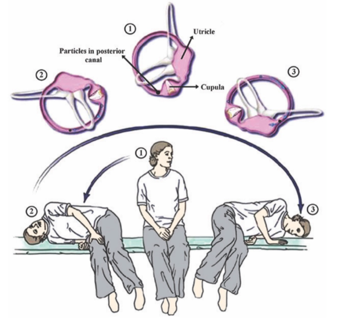 BPPV benign paroxysmal positional vertigo 양성 돌발성 두위 현훈 : 네이버 블로그