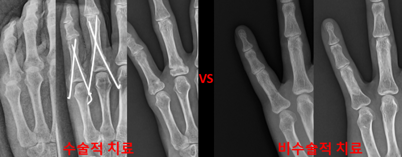 손가락 골절proximal Phalanx Fracture은 무조건 수술해야 하나요 비수술 치료로 가능한 경우가 많습니다
