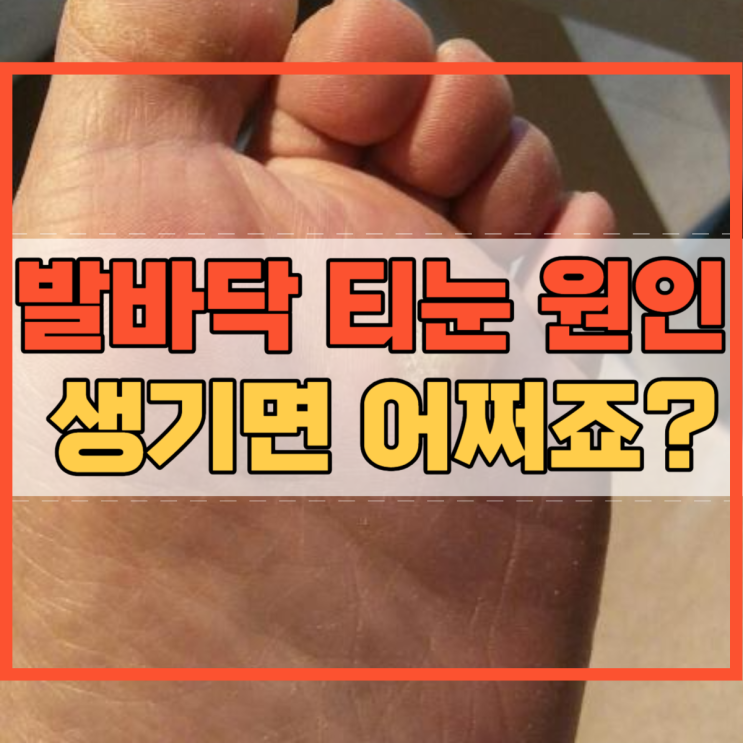 발바닥 티눈 원인 생기면 어떻게 해야 할까요