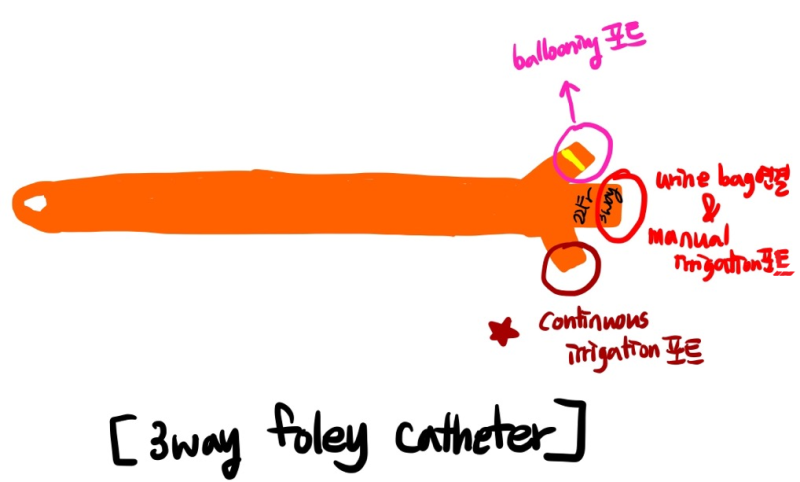 혈뇨(hematuria) 있을 때 지속적 방광 세척 (continuous bladder irrigation) 하는 방법 ...