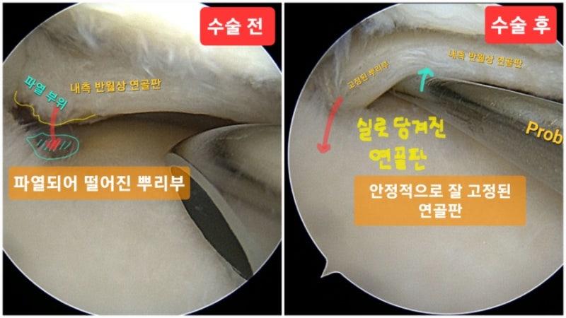 무릎에서 뚝 하는 소리 나며 발생한 내측 반월상 연골판 파열 수술이 꼭 필요합니다 60대 여성 관절경 골 터널 봉합술