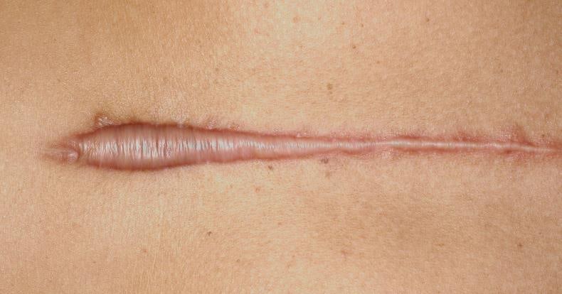 켈로이드 keloid [L91.0] 진단, 치료방법, 비후성 반흔 Hypertrophic scar과 차이점(감별) : 네이버 블로그