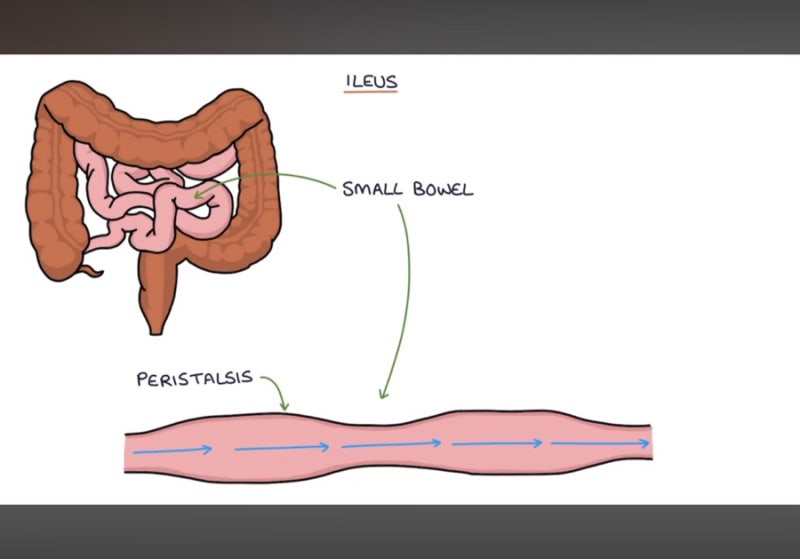 Ileus 장폐색 증상, 진단, 치료, 입원, 음식 공부하기 : 네이버 블로그