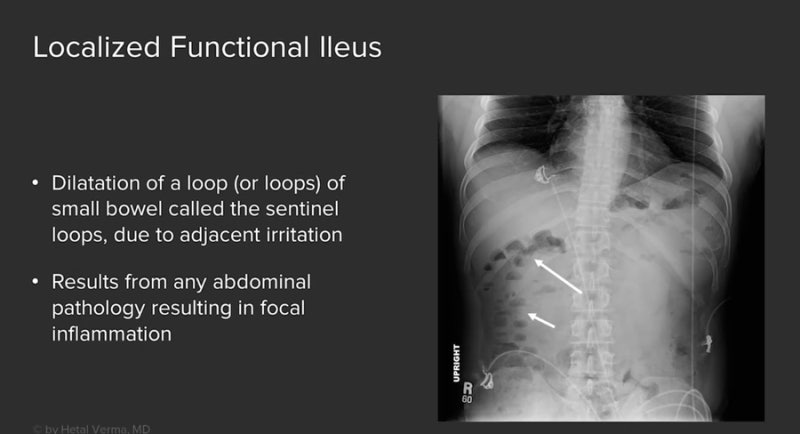Ileus 장폐색 증상, 진단, 치료, 입원, 음식 공부하기 : 네이버 블로그