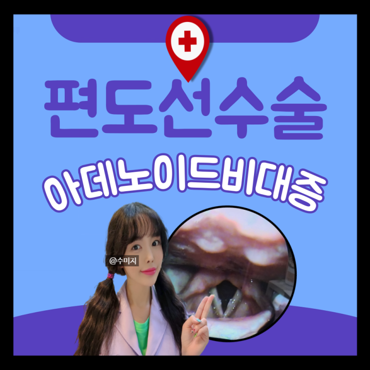 구개편도염 급성편도염 편도선염 증상 편도염 열 약 원인 전염 편도농양 편도 부었을때 아이스크림