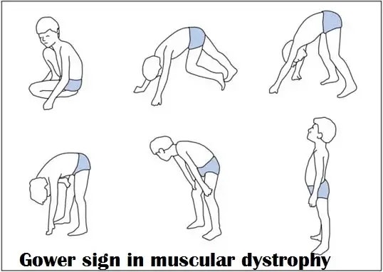 희귀질환 _ 듀시엔형 근이영양증(Duchenne Muscular Dystrophy) : 네이버 블로그