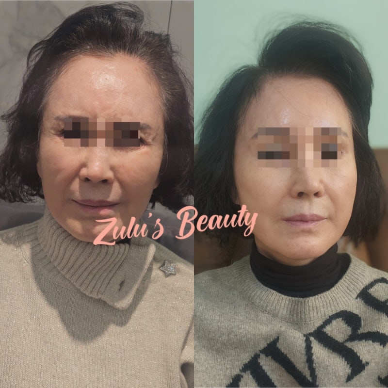 실루엣플리프팅이마 미간 보톡스 눈가주름 당일 효과 가격 전후 부작용 붓기 실루엣소프트 후기 네이버 블로그