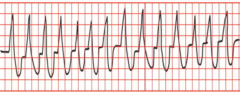 ECG 초보 탈출하기 : Ventricular tachycardia(심실빈맥, V-tach) : 네이버 블로그