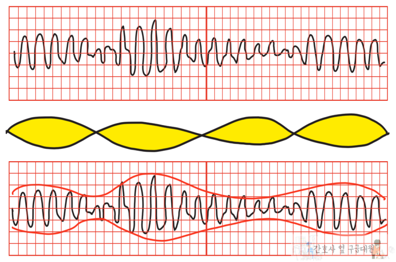 ECG 초보 탈출하기 : Ventricular tachycardia(심실빈맥, V-tach) : 네이버 블로그